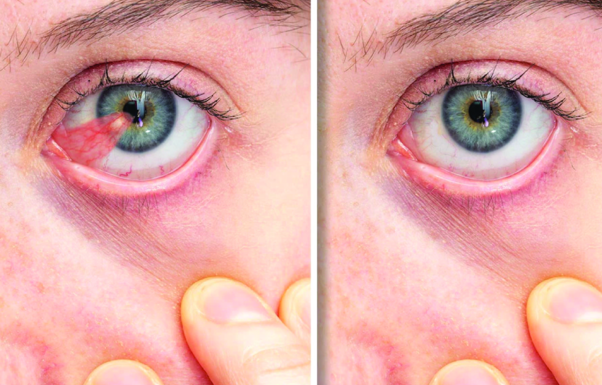 Eyelid Tumors - Eye Surgeon Clinics